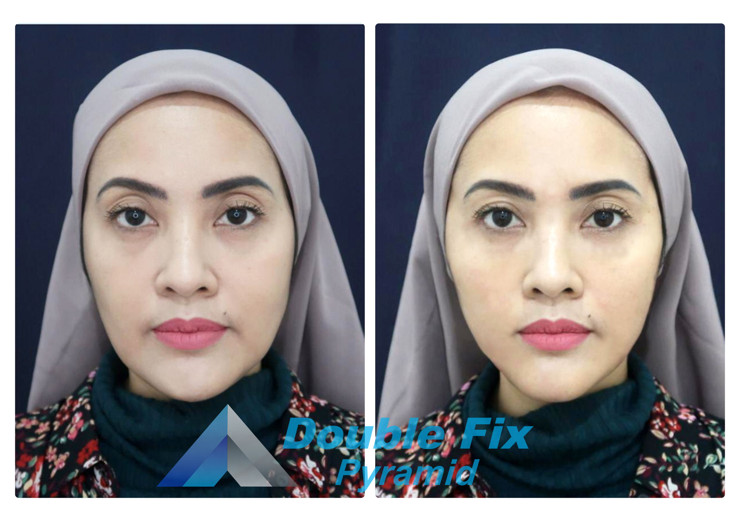 Lifting Sagging Skin for Elma Theana - PT. Pharmindo Rimpang Kokoh