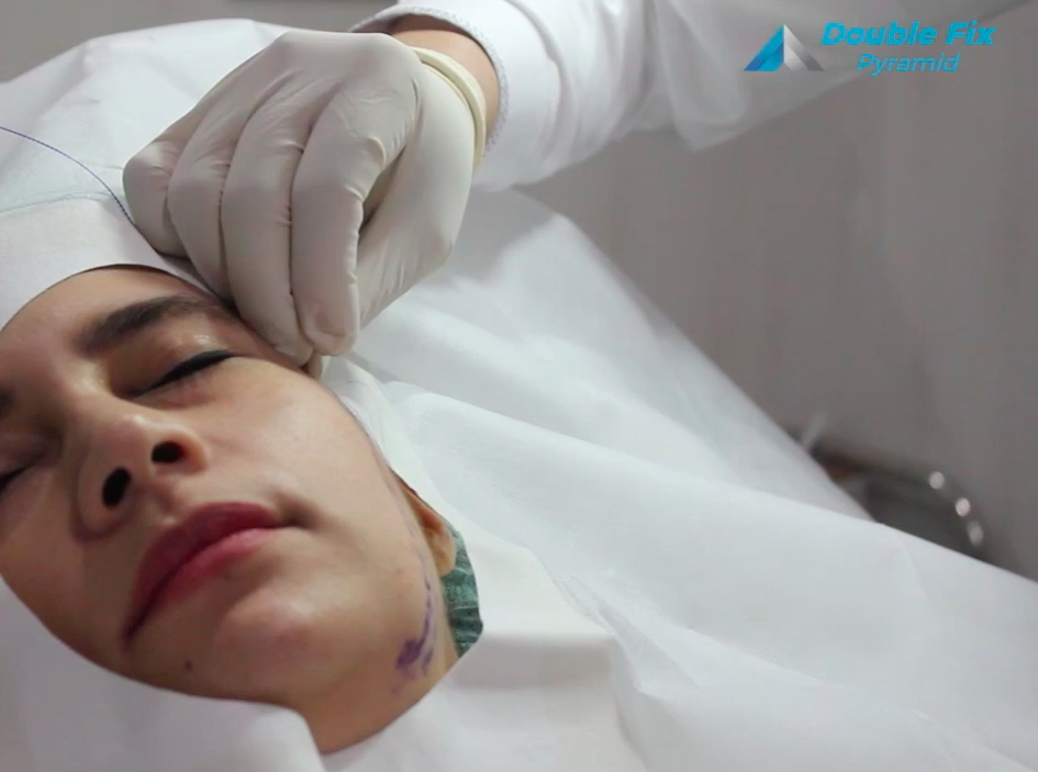 Technology used in Double Fix-Pyramid Thread